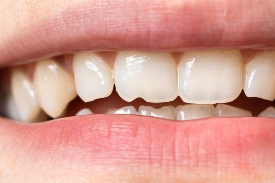 Why Do My Teeth Look Translucent? - General Dentists in Media, PA