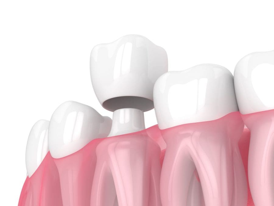 Can Dental Crowns Break? - Emergency Dentists in Media, PA