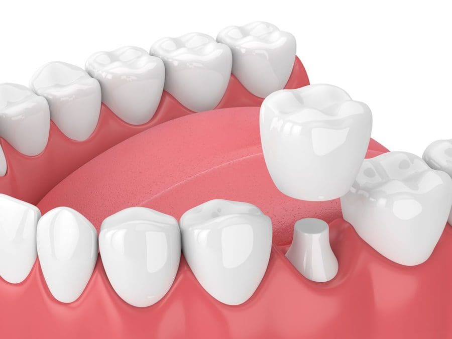 The Dental Crown Process: Step By Step - Dentists in Media, PA